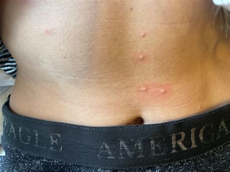 What Type Of Bug Would Cause Bites Like These Rwhatbugisthis