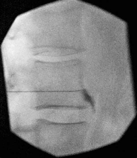 Radiofrequency Ablation And Pulsed Radiofrequency Ablation For The Sympathetic Nervous System