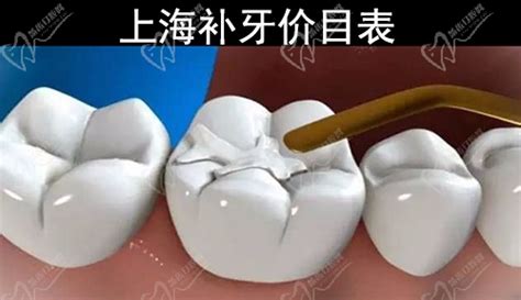 上海正规医院补牙多少钱一颗？公布2022年补牙收费价目表口腔行业资讯皓齿口腔网