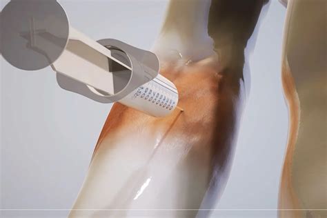 How Injectables For MS Work