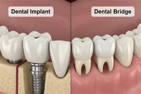 Dental Implants Vs Dental Bridges A Complete Patient Guide Hastings