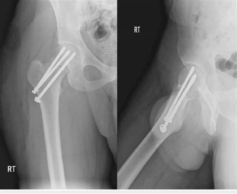 Ap And Lateral View Follow Up X Rays Of The Right Hip Showing Accepted