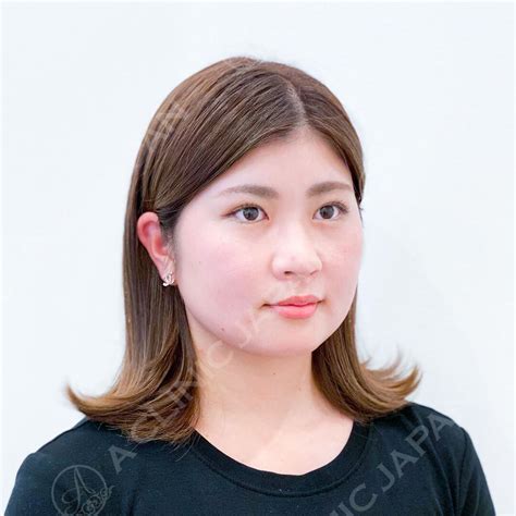 小顔施術なのにダウンタイム最小限！当日からお出かけも楽々！aスレッドの処置前と処置直後の症例です20代女性 A Clinicは小顔