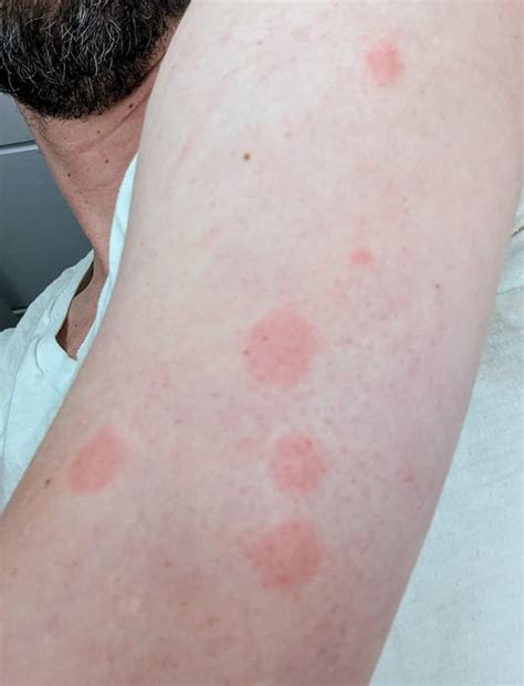 Are These Bedbug Bites R Bugbites