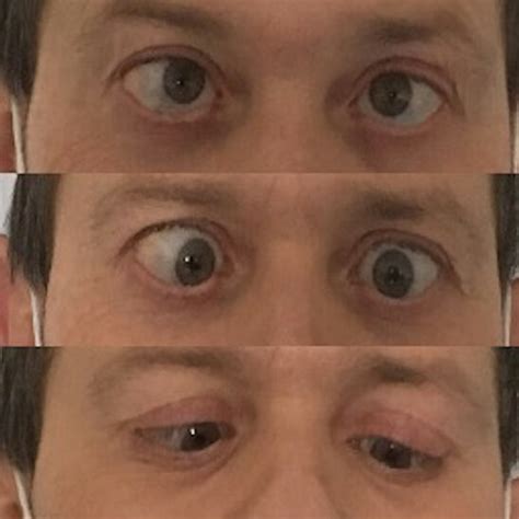 Photographs Five Weeks After Surgery Showing Reduced Esotropia