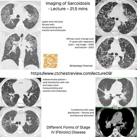 Bhavin Jankharia On Linkedin Lecture Imaging Of Sarcoidosis Apart