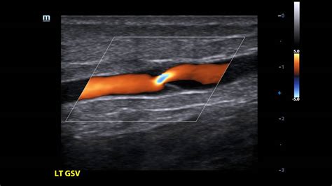 Venous Insufficiency Ultrasound Worksheet