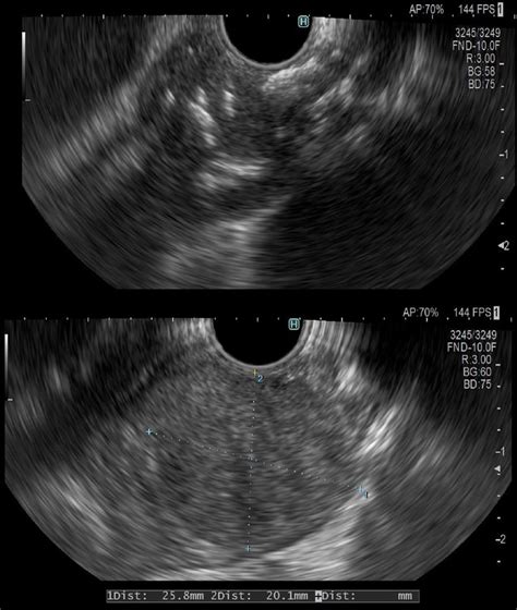 Latest Learning Case Friends Of Endoscopy