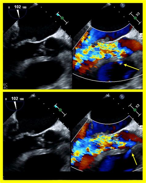 Quadruple Native Valve Infective Endocarditis Rec Cardioclinics