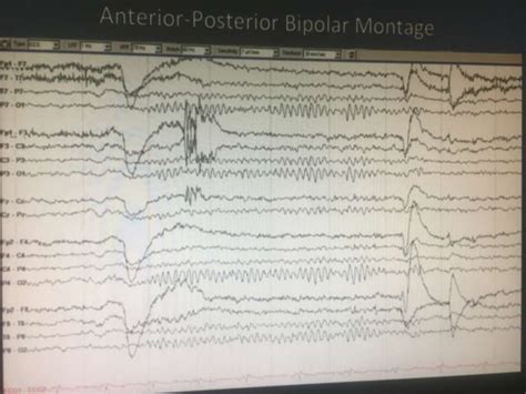 EEG INTERPRETATION PPTX