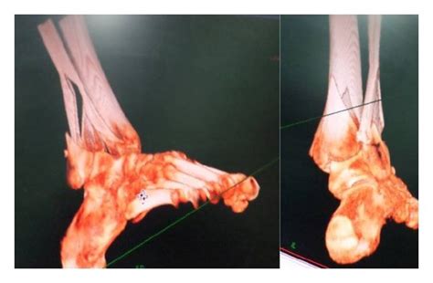A Pilon Fracture With A Major Posterior Malleolar Fragment Is Seen
