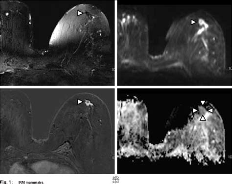 Figure 2 From Diffusion En Irm Mammaire Semantic Scholar