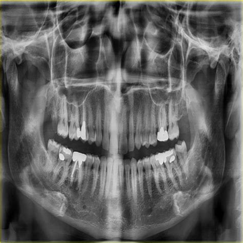 Toothrobo Instance Segmentation Model By Blah
