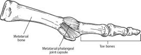 Capsulitis Treatment Foot Doctor Southlake Keller Flower Mound