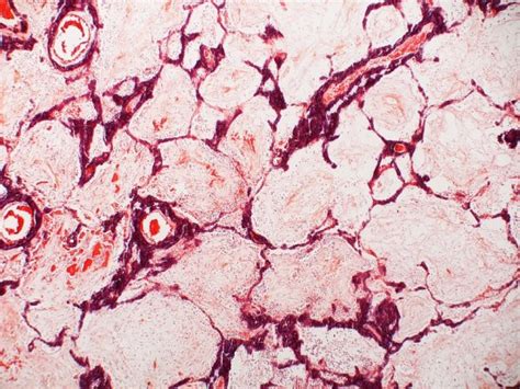 Difference Between Dystrophic And Metastatic Calcification Compare The Difference Between