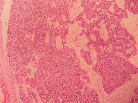 Oncocytoma Histopathologyguru