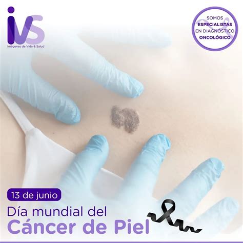 De Junio D A Mundial Del C Ncer De Piel Im Genes De Vida Y Salud