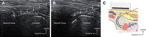 Ultrasound Guided Versus Blind Temporomandibular Joint Injections A