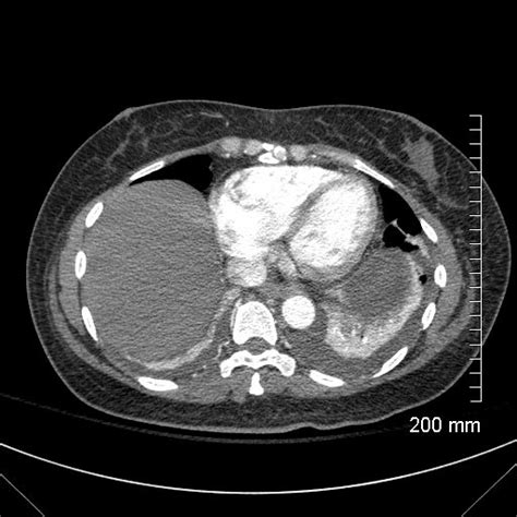 238lu Complex Loculated Pleural Effusions Lungs