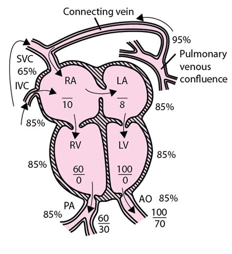 Imagetotal Anomalous Pulmonary Venous Return Msd Manual Professional