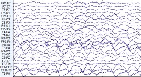 towards automated epileptic seizure detection for lightweight devices