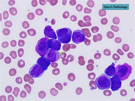 Qiaos Pathology Acute Promyelocytic Leukemia Apl Aml M3 A Photo On Flickriver
