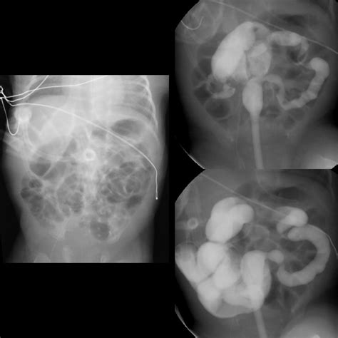 Necrotizing Enterocolitis Pediatric Radiology Reference Article
