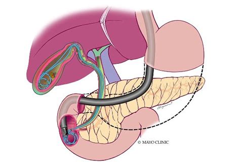 Endoscopic Retrograde Cholangiopancreatography Guided Transpapillary Gallbladder Drainage Ergd