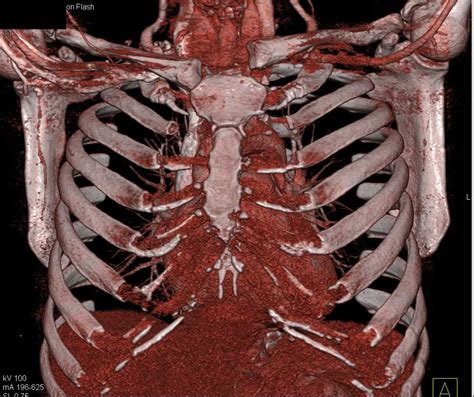 Infection Left Sternoclavicular Joint Sc Joint Musculoskeletal