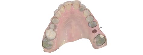 STL File Digital Surgical Guide Planned Implant 3D Print Design To