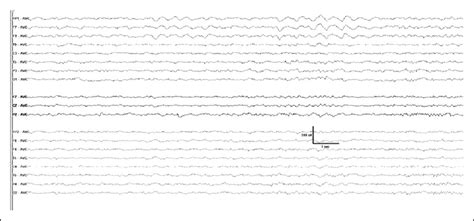 Electroencephalographic Findings In Patient 1 Left Temporal