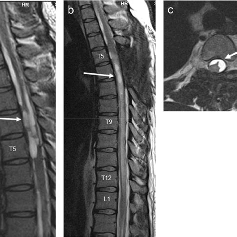 Pdf Spinal Adhesive Arachnoiditis Three Case Reports And Review Of
