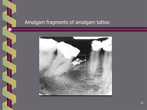 Amalgam Tattoo Cancer Treatment At Ebony Dunlop Blog