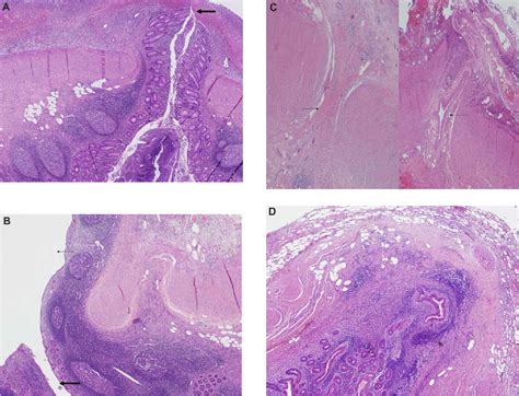 Diverticulosis Histology