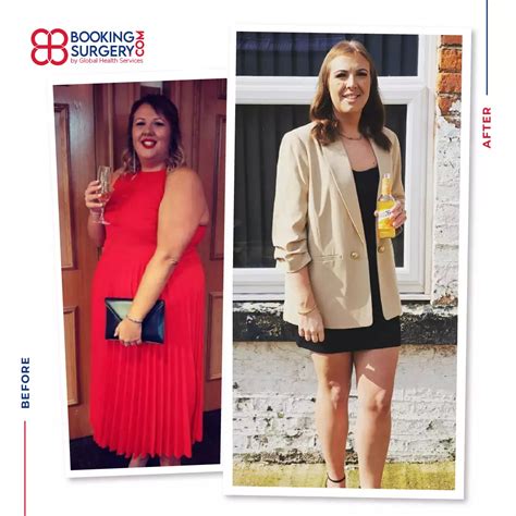 Mini Gastric Bypass Mgb Surgery Booking Surgery