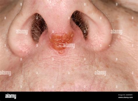 How Do You Get Cold Sores Up Your Nose At Jaime Cardenas Blog