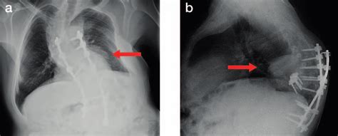 Plain Chest X Ray Revealed Enlargement Of Soft Tissues In The Left Download Scientific Diagram
