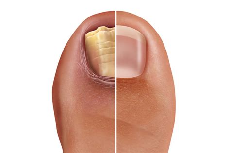 15 Things Your Nails Can Say About Your Health Factspedia