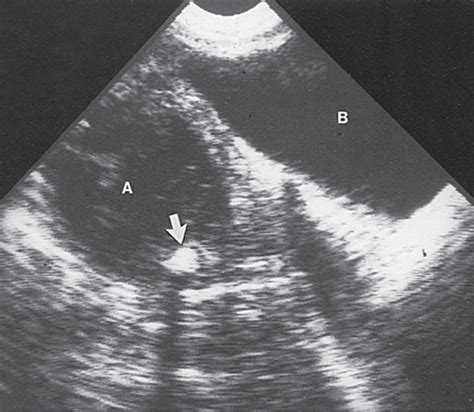 Appendicitis Pediatric Diseases And Conditions 5minuteconsult