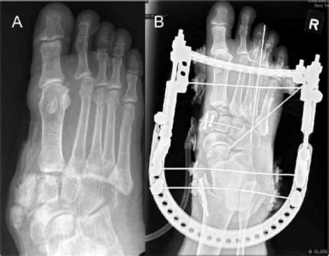 A Radiograph Showing Right Foot Lisfranc Dislocation With Cuneiform Download Scientific