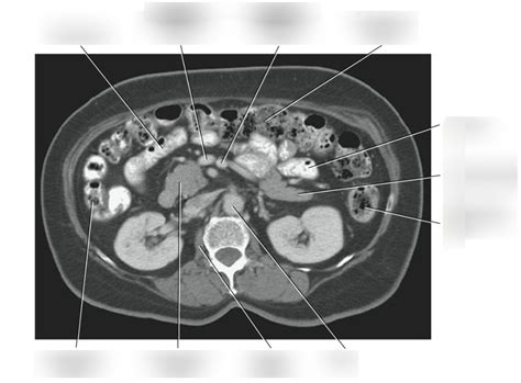 Axial Abdomen Ct 4 49 Diagram Quizlet