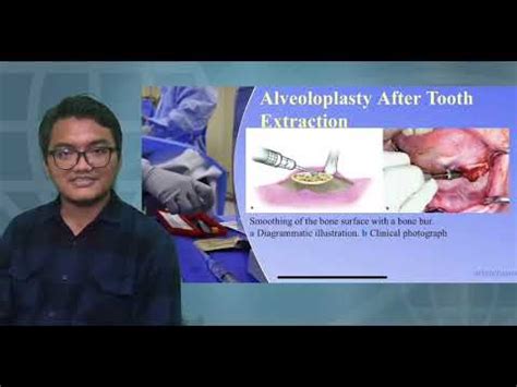 Alveoloplasty Youtube