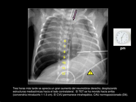 Ppt Tubo Endotraqueal Powerpoint Presentation Free Download Id1001504