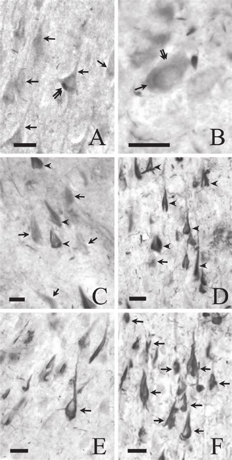Activated Caspase 3 Labelling Of Tau Bearing Hippocampal Neurons In