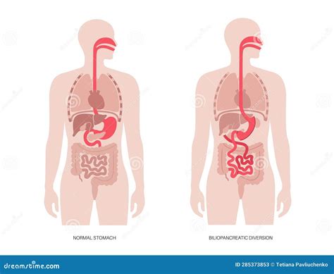 Biliopancreatic Diversion Procedure Vector Illustration Cartoondealer