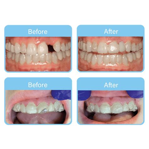 Retainer For Missing Teeth