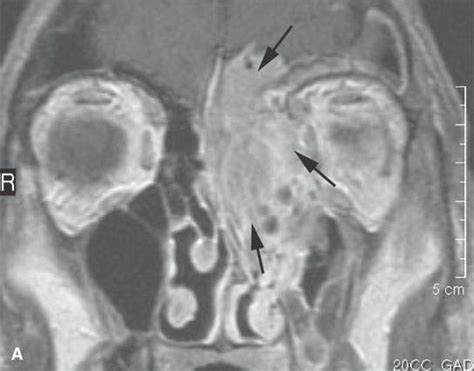Benign And Malignant Neuroectodermal And Other Neurogenic Tumors Radiology Key