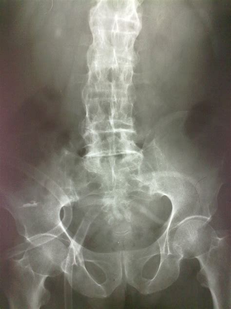 Bamboo Spine Ankylosing Spondilitis Radiology