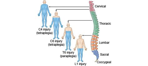 Paraplegia Definition Causes Symptoms Types Treatment 40 Off
