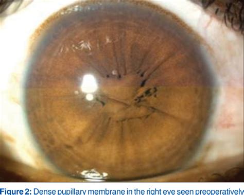 Figure 1 From A Rare Case Of Persistent Pupillary Membrane Case Based